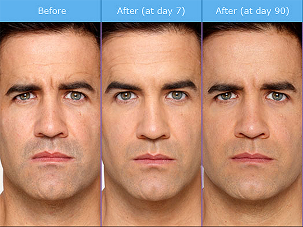 Hablando de Botox con el Dr. Antonio Licitra | BellezaPura