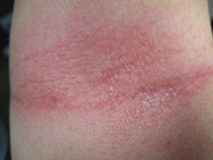 Dermatitis atópica, la importancia de cuidarse desde niños | BellezaPura